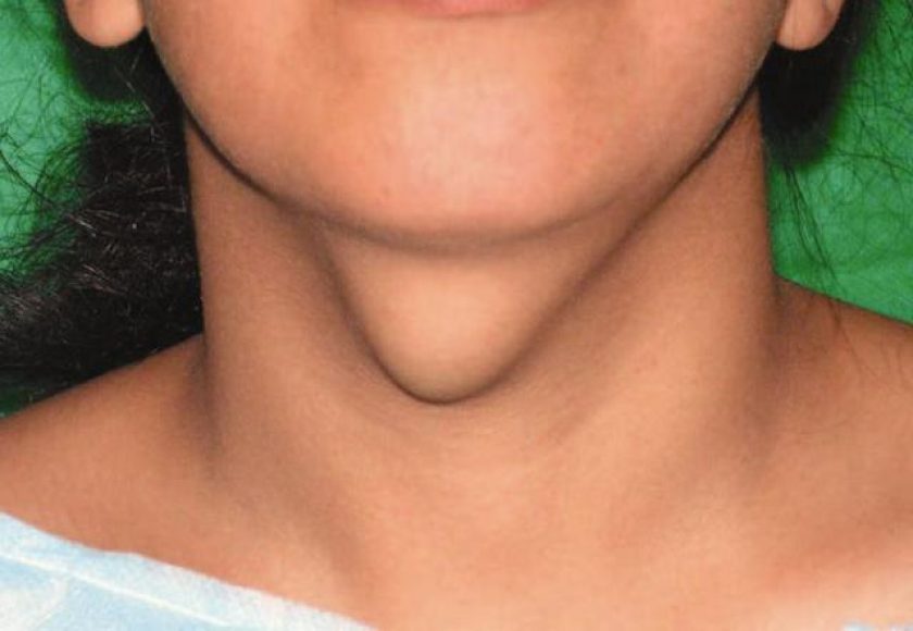 Diffuse toxic goiter. It's important to know